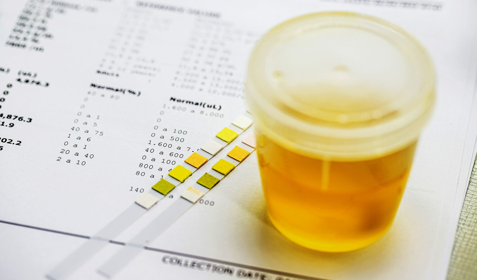 Azotyny w moczu - co oznaczają? Jakie są ich przyczyny?