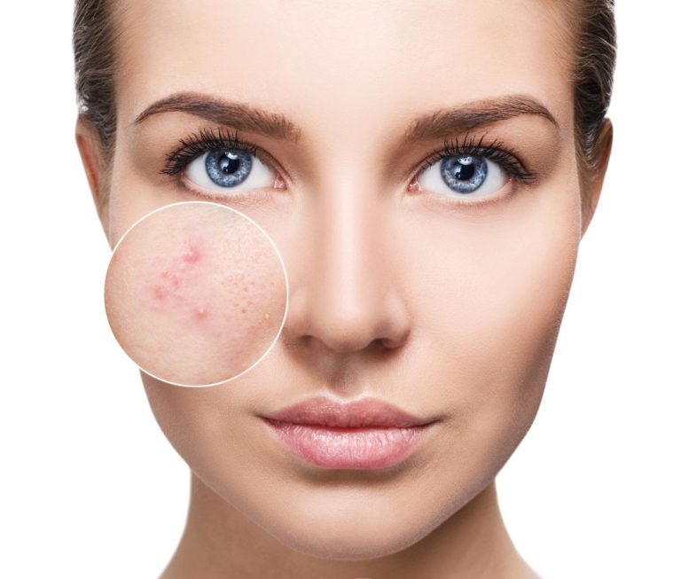 Torbiel - czym jest, gdzie występuje i czy jest groźna dla zdrowia?