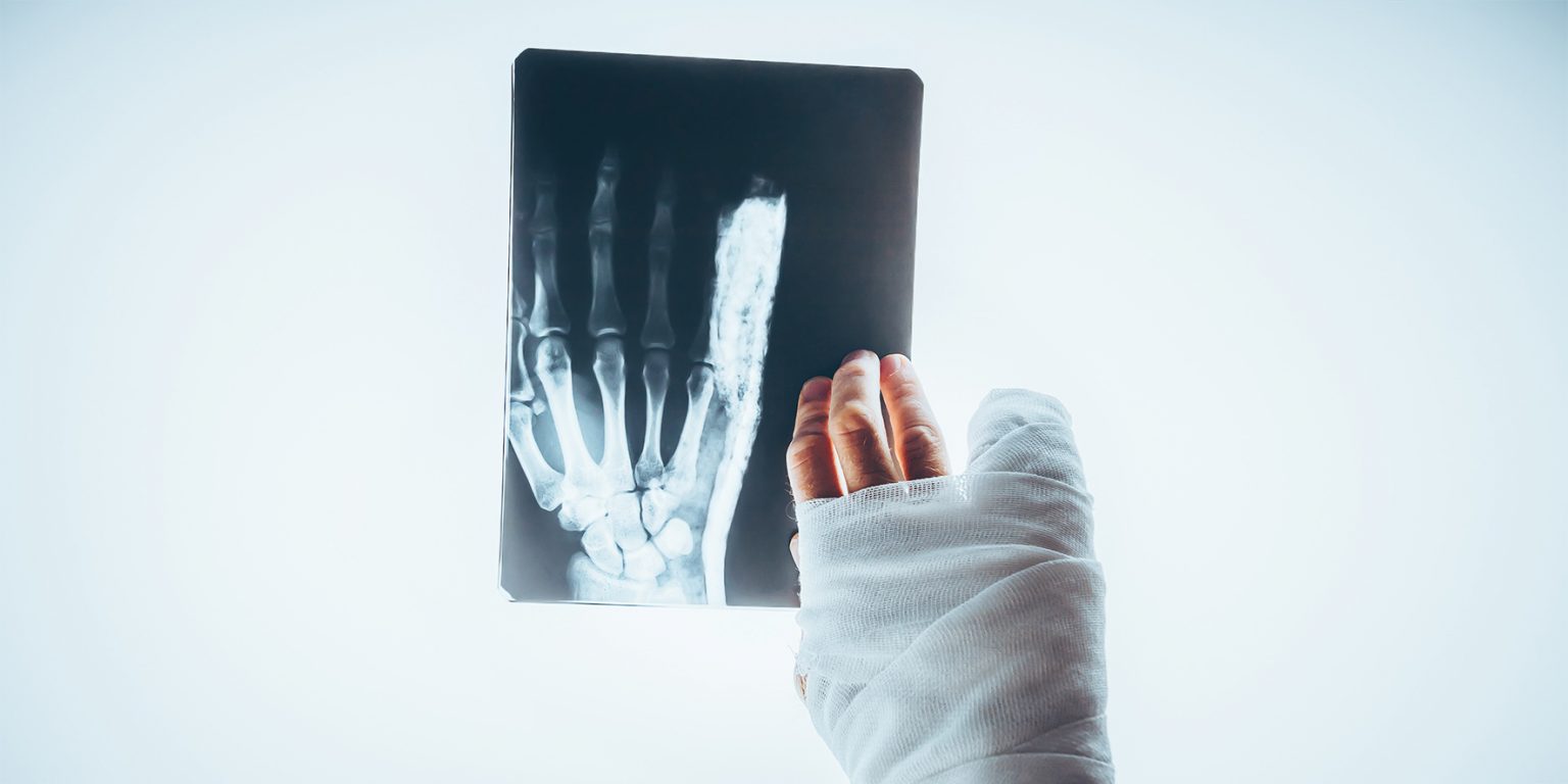 Osteofitoza krawędziowa – przyczyny, objawy, leczenie - HelloZdrowie