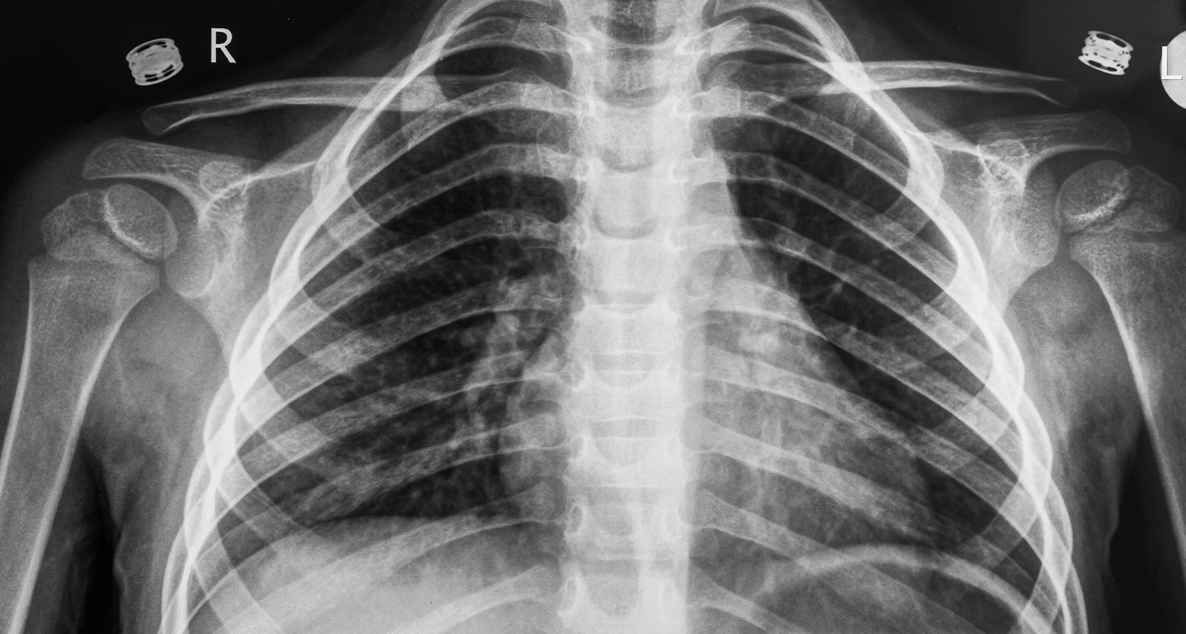 Czym jest choroba Scheuermanna? Objawy, leczenie | HelloZdrowie