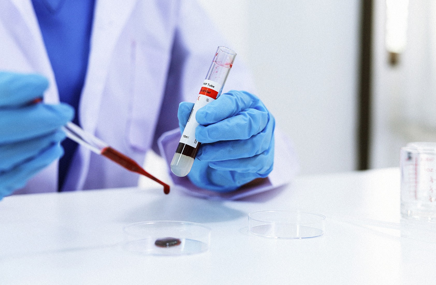 GGTP (gamma-glutamylotranspeptydaza) – badanie, normy | HelloZdrowie