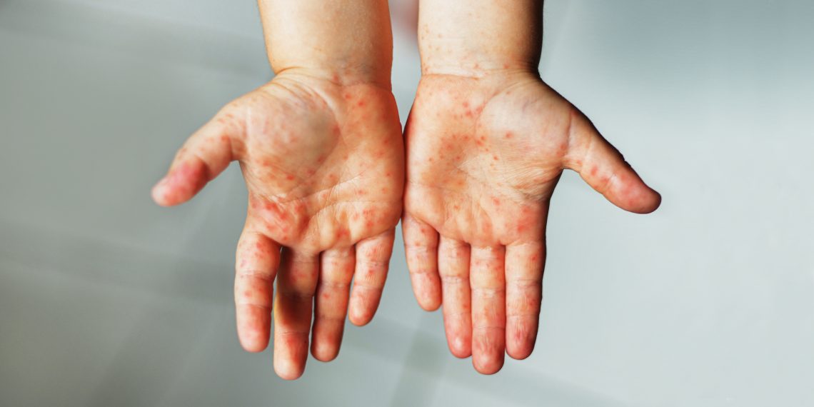 Bostonka (choroba bostońska). Jakie są objawy? Jak zapobiegać?