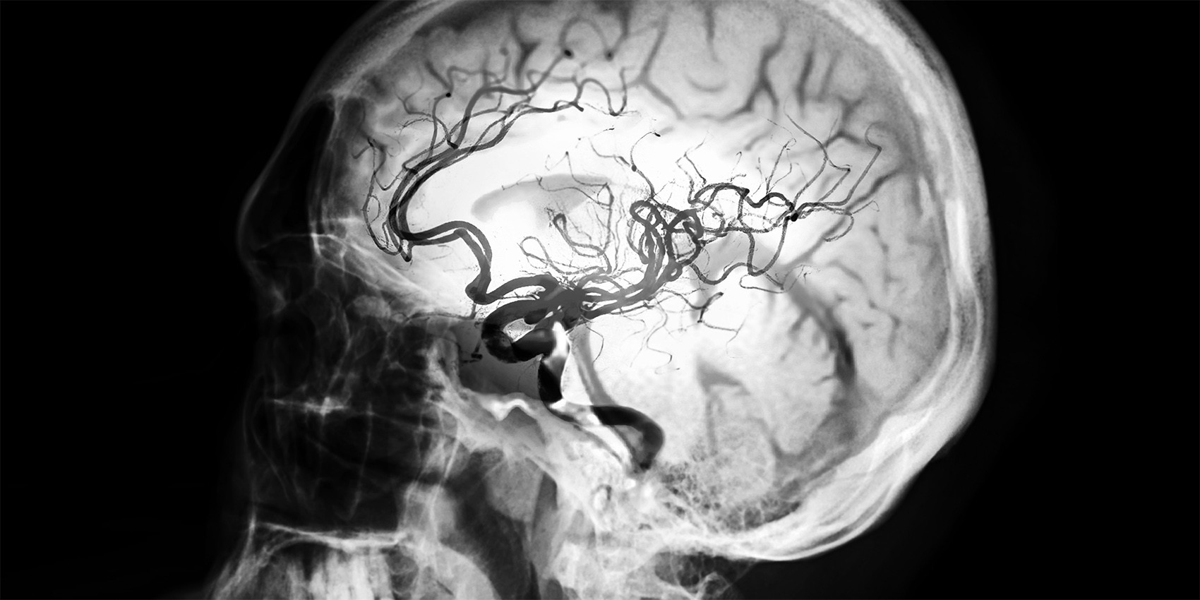 Wylew krwi do mózgu – przyczyny, objawy i leczenie udaru krwotocznego