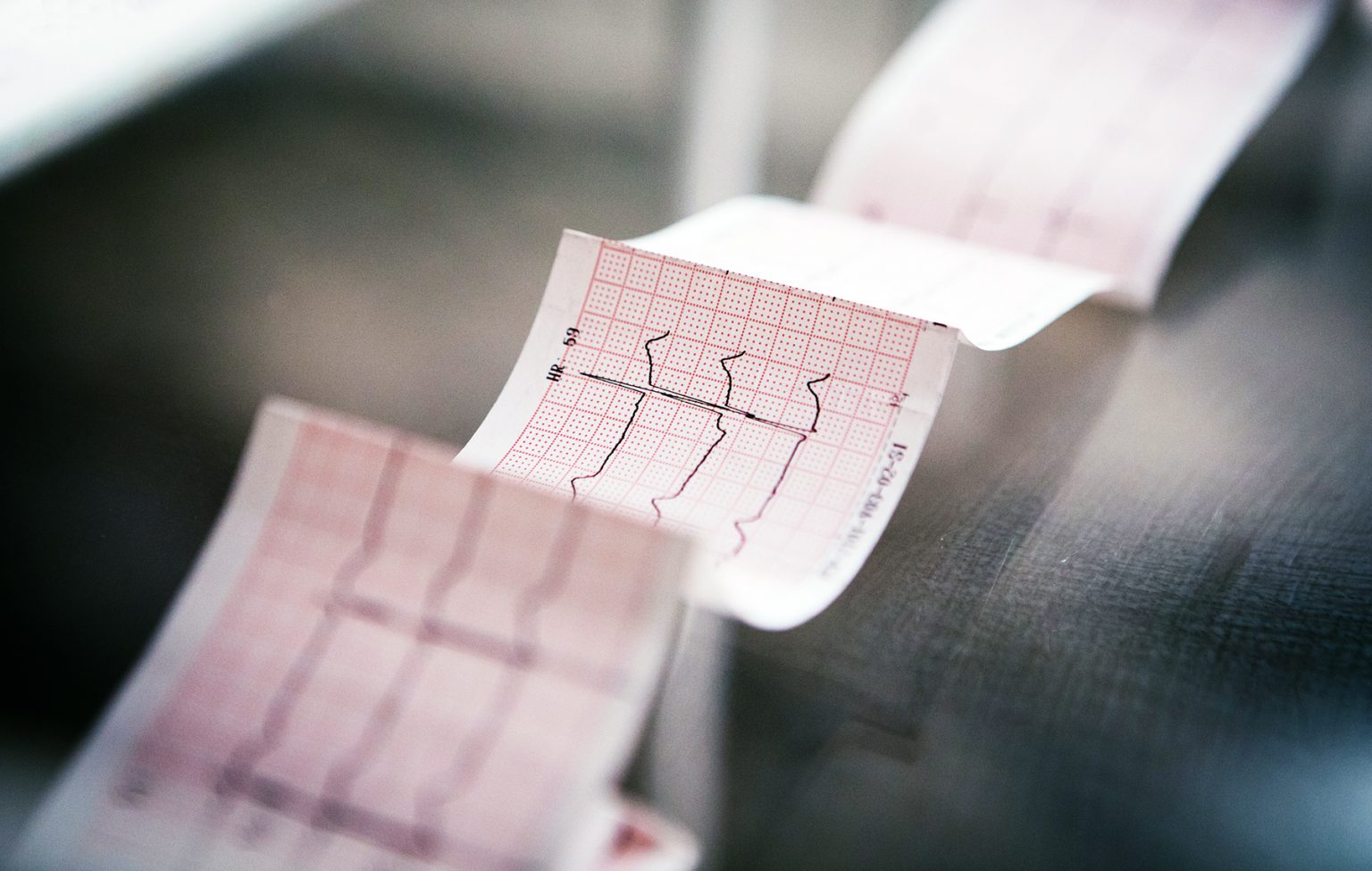 RBBB (blok prawej odnogi pęczka Hissa) - objawy i leczenie | HelloZdrowie