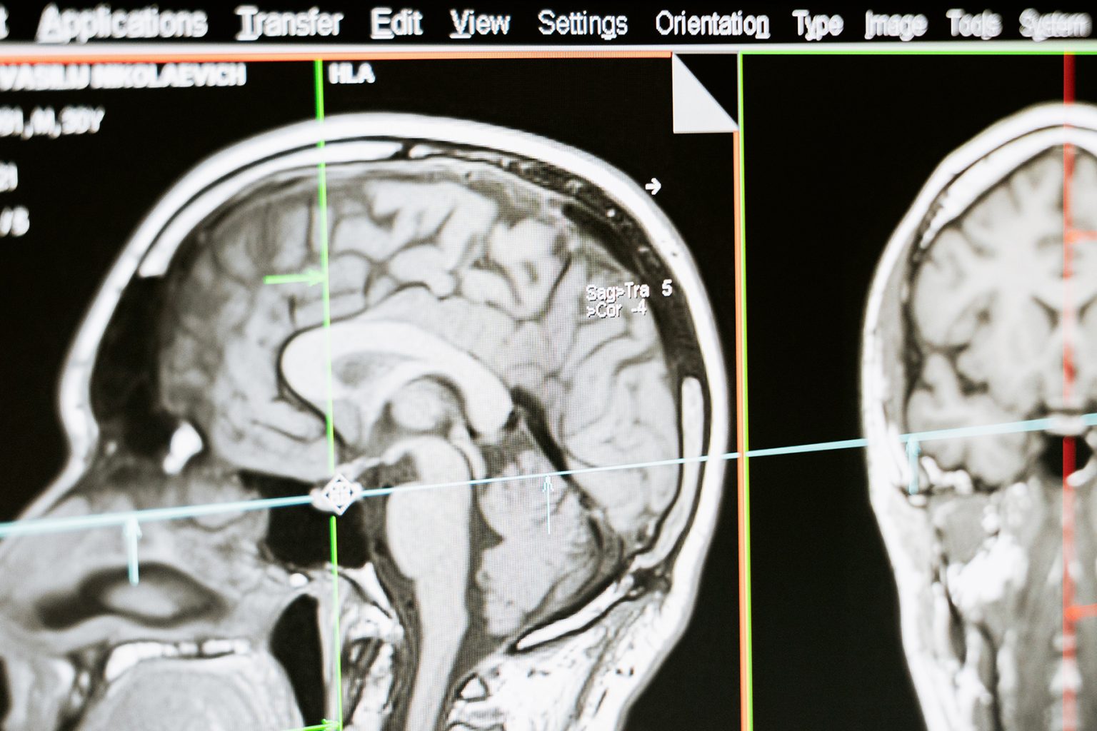 Płyn mózgowo-rdzeniowy – funkcje, wskazania do badania i interpretacja ...