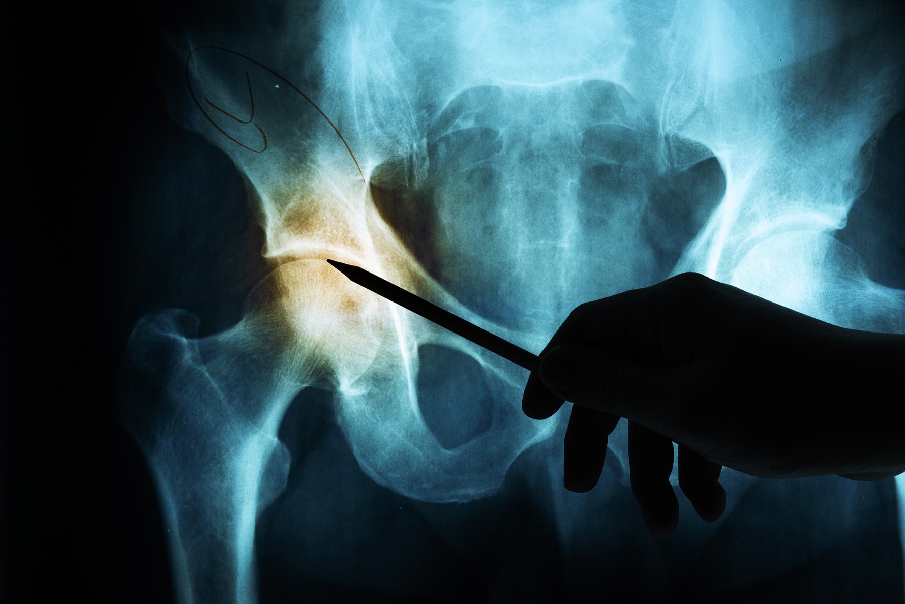 Osteofitoza krawędziowa – przyczyny, objawy, leczenie - HelloZdrowie
