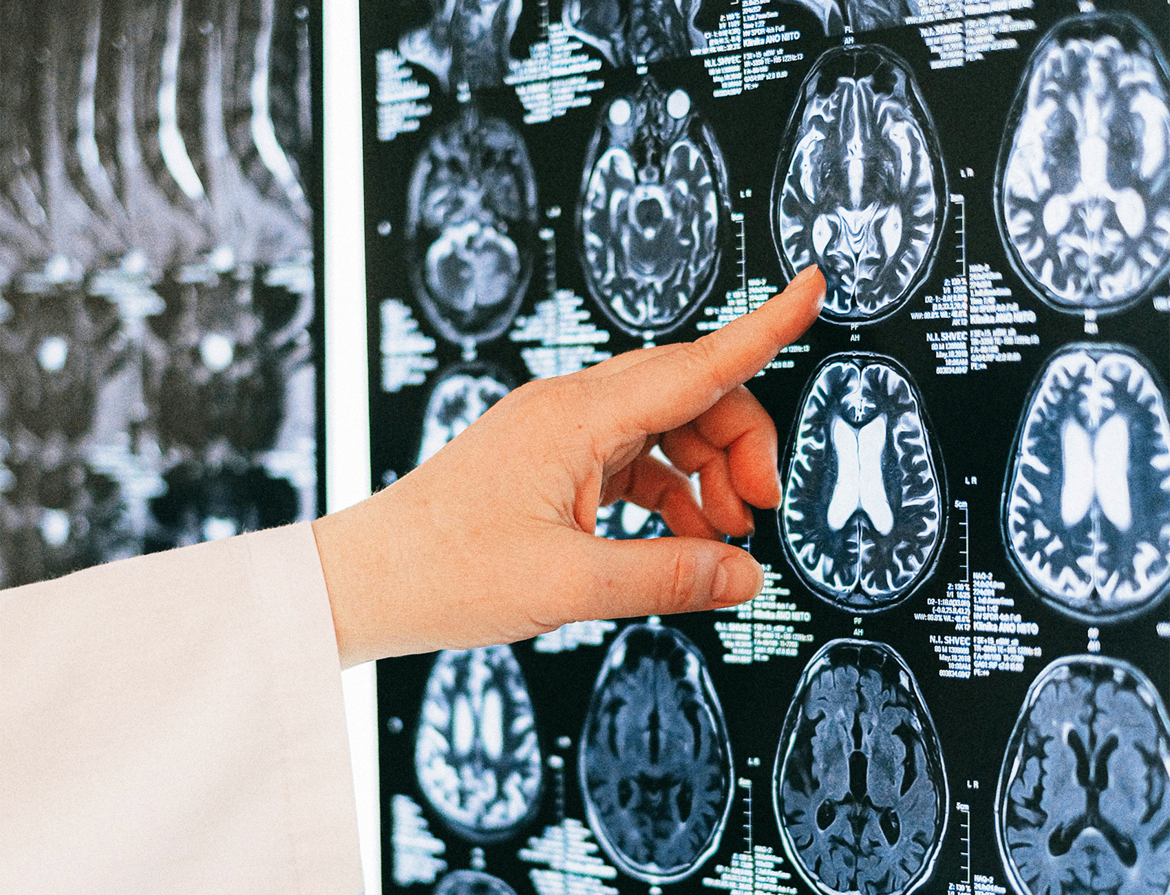 Osteofitoza krawędziowa – przyczyny, objawy, leczenie - HelloZdrowie