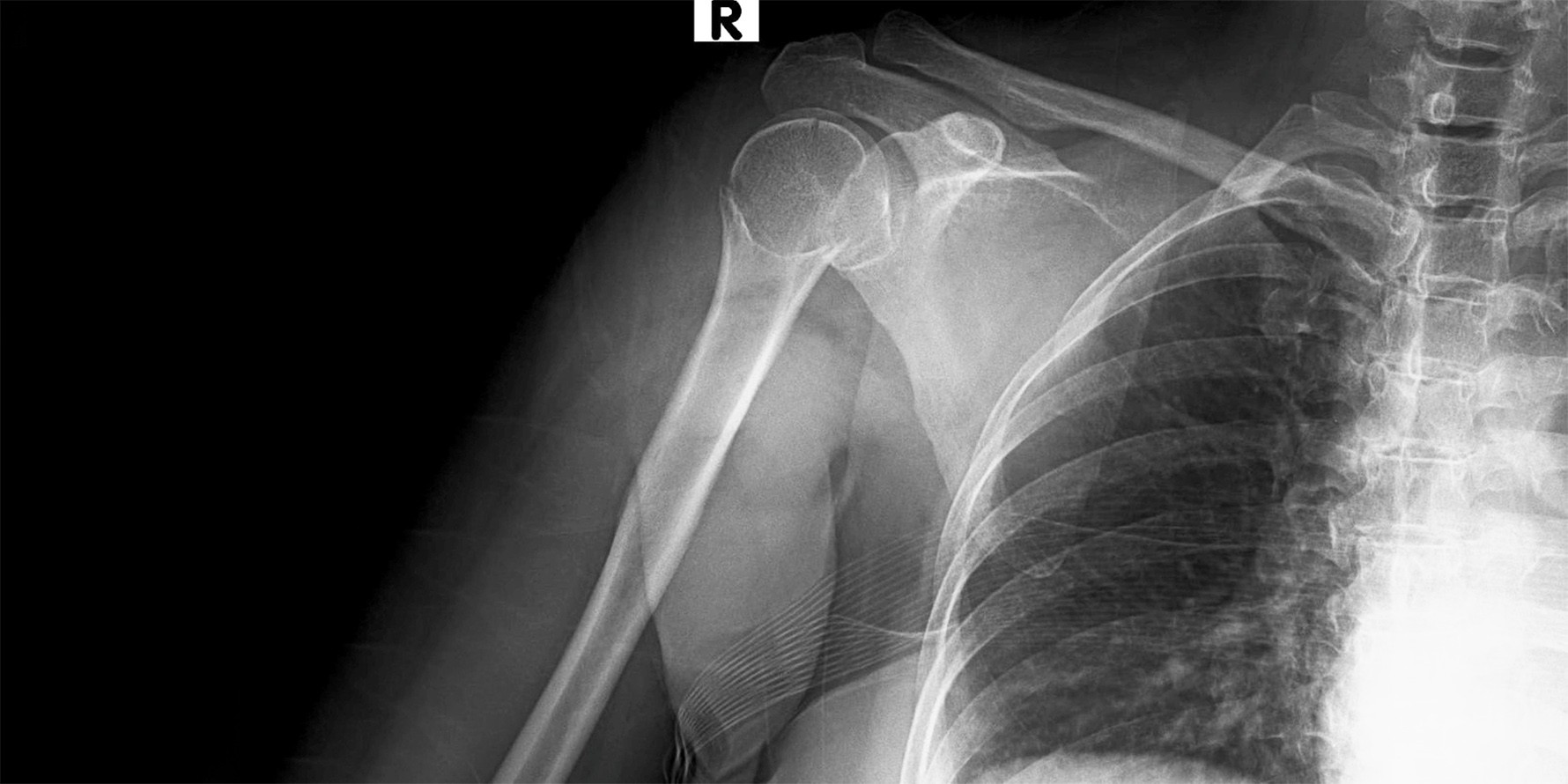 Kość ramienna – budowa i funkcje. Objawy złamania kości ramieniowej ...