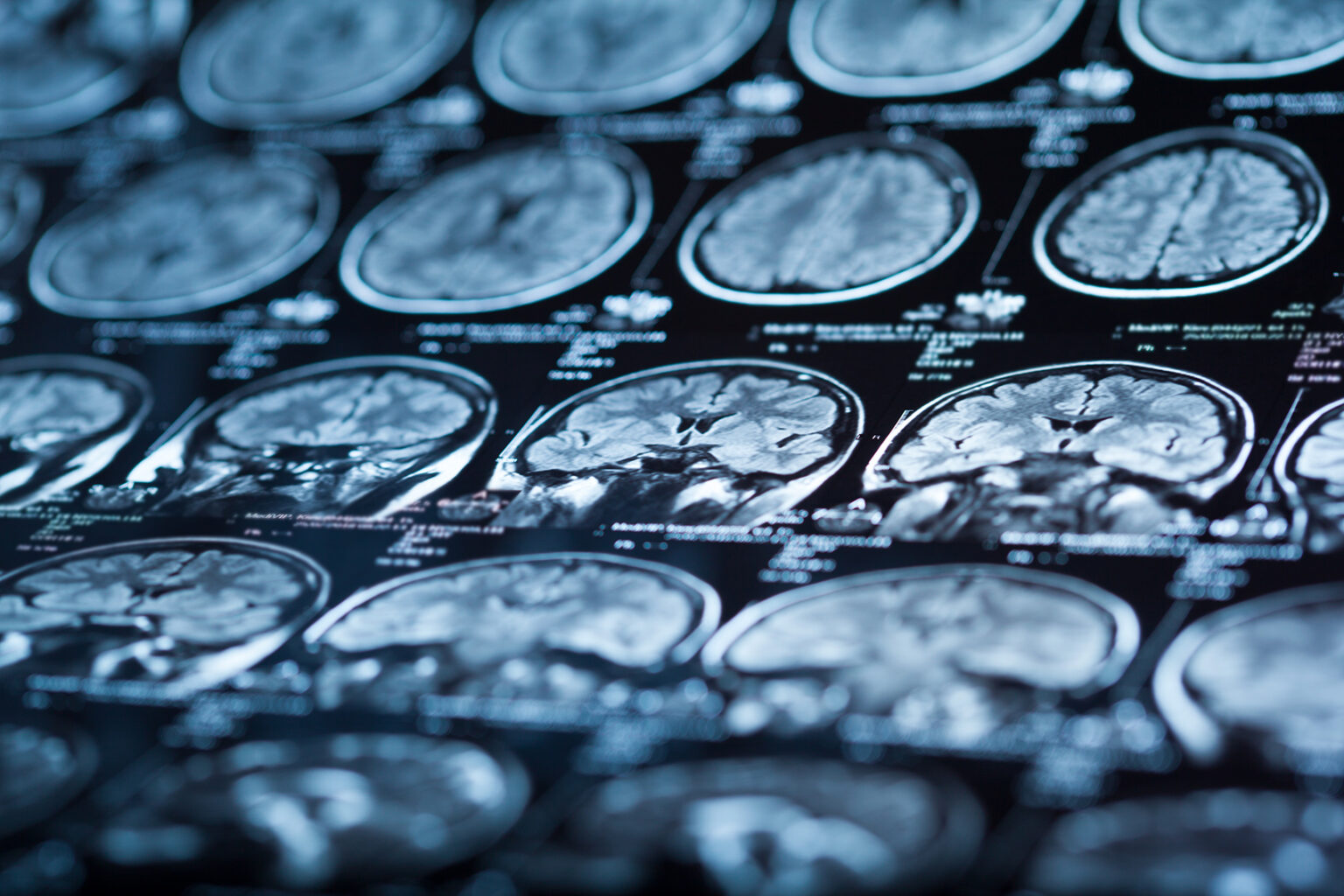 Torbiel przysadki mózgowej, czyli torbiel kieszonki Rathkego - HelloZdrowie