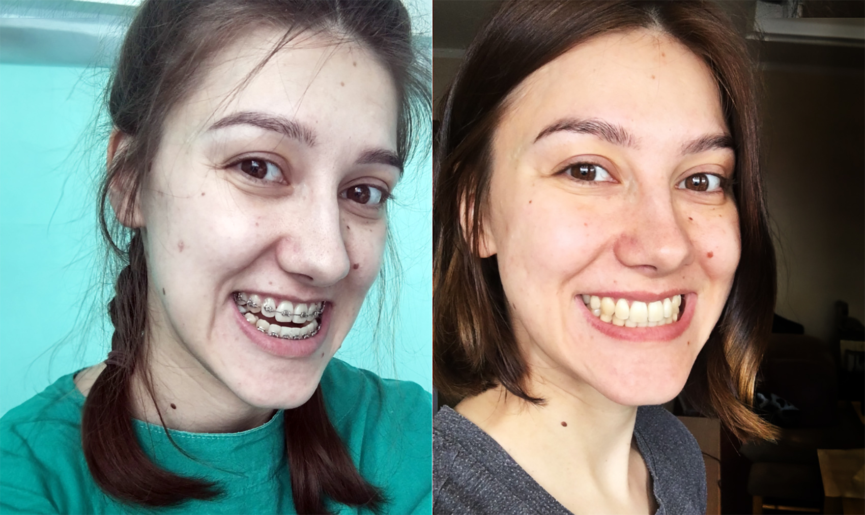 Progenia to wrodzona wada zgryzu. Jakie daje objawy? - HelloZdrowie