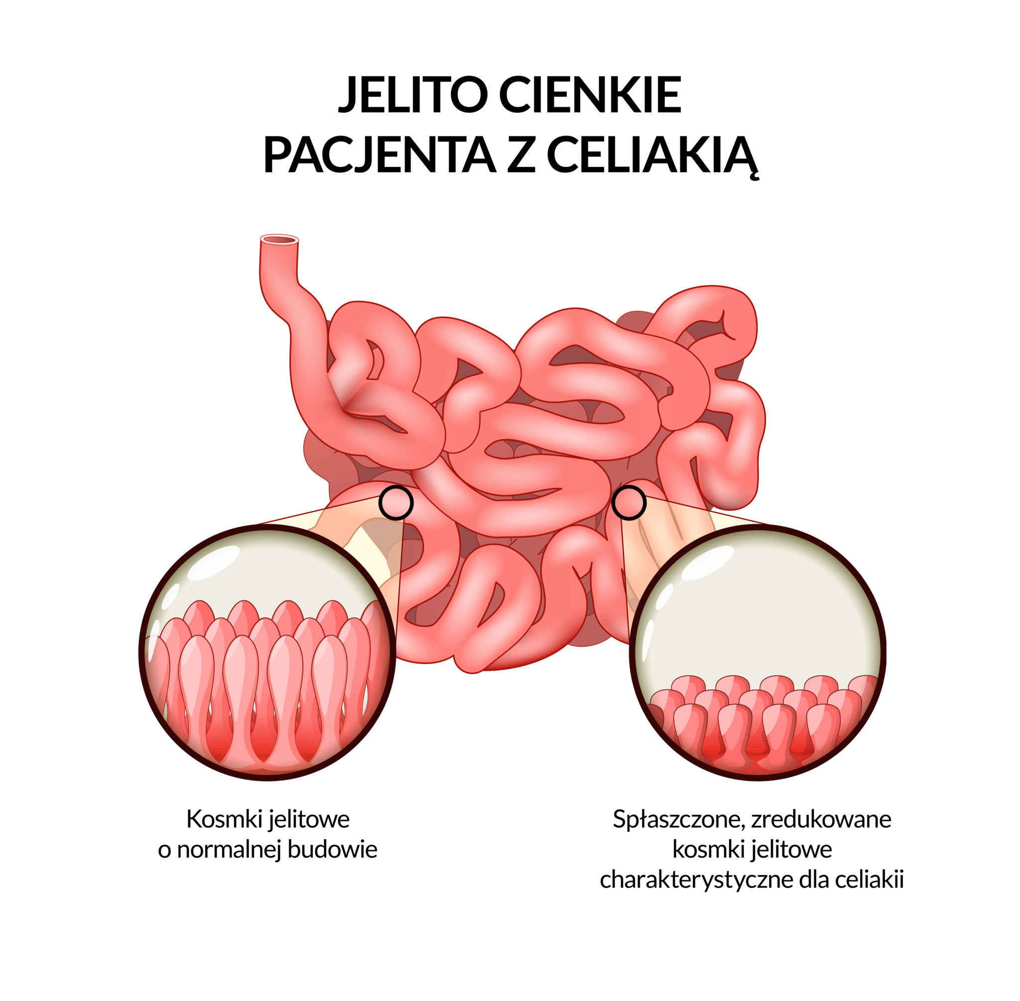 Celiakia: objawy to nie tylko problemy gastryczne i symptomy skórne ...