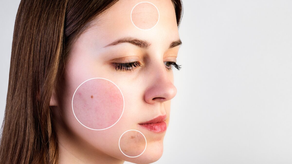 Piodermia zgorzelinowa – przyczyny, objawy, leczenie - HelloZdrowie