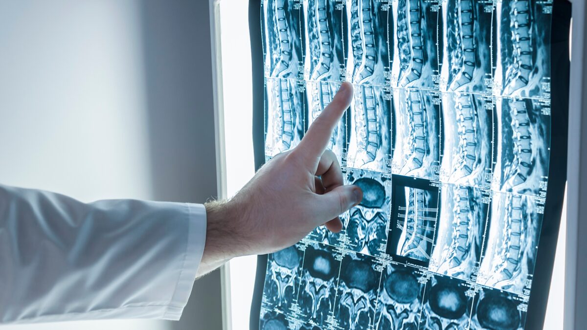 Zespół Gilberta – objawy, dieta, dziedziczenie, badania | HelloZdrowie