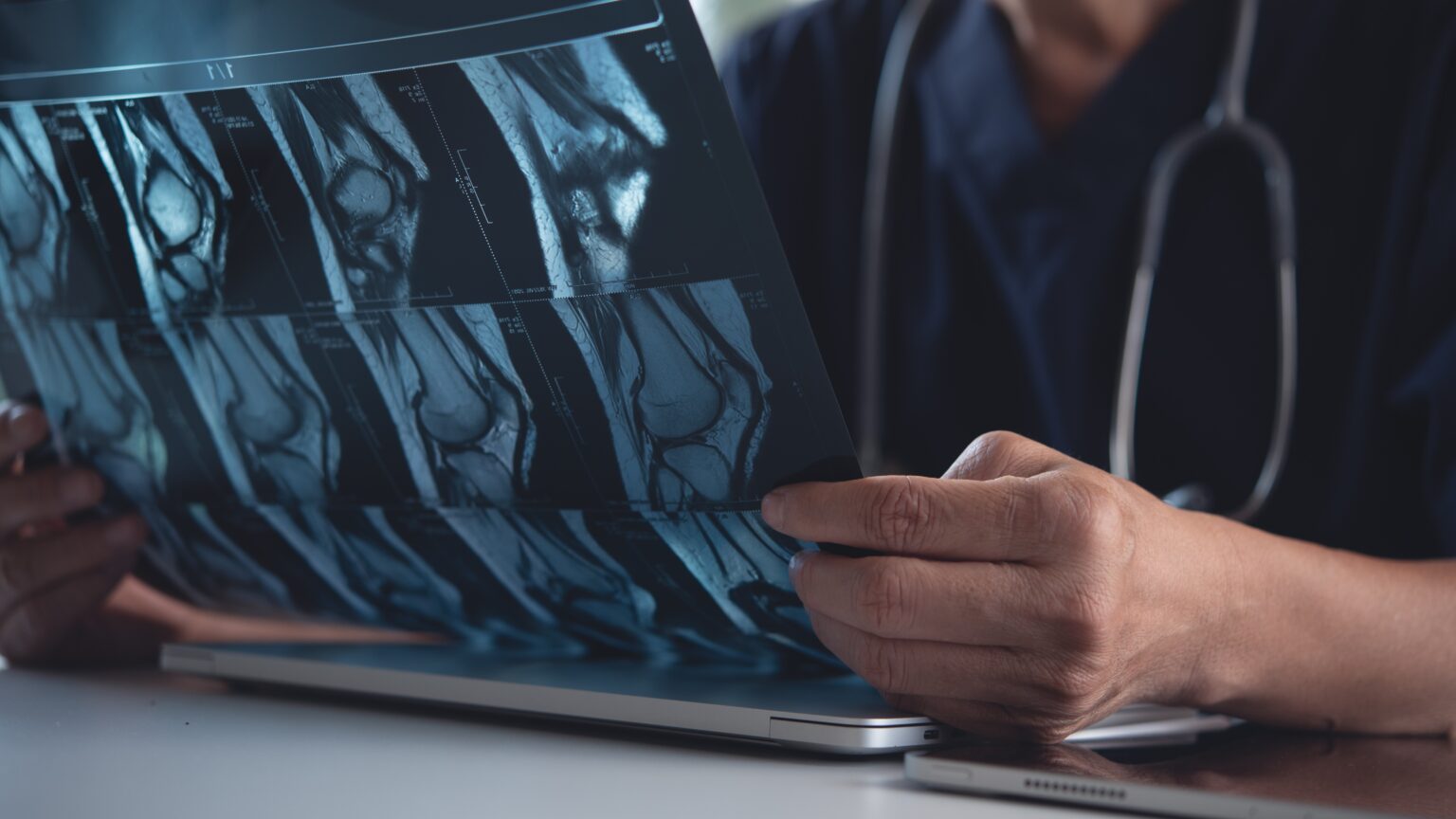 Osteofitoza krawędziowa – przyczyny, objawy, leczenie - HelloZdrowie