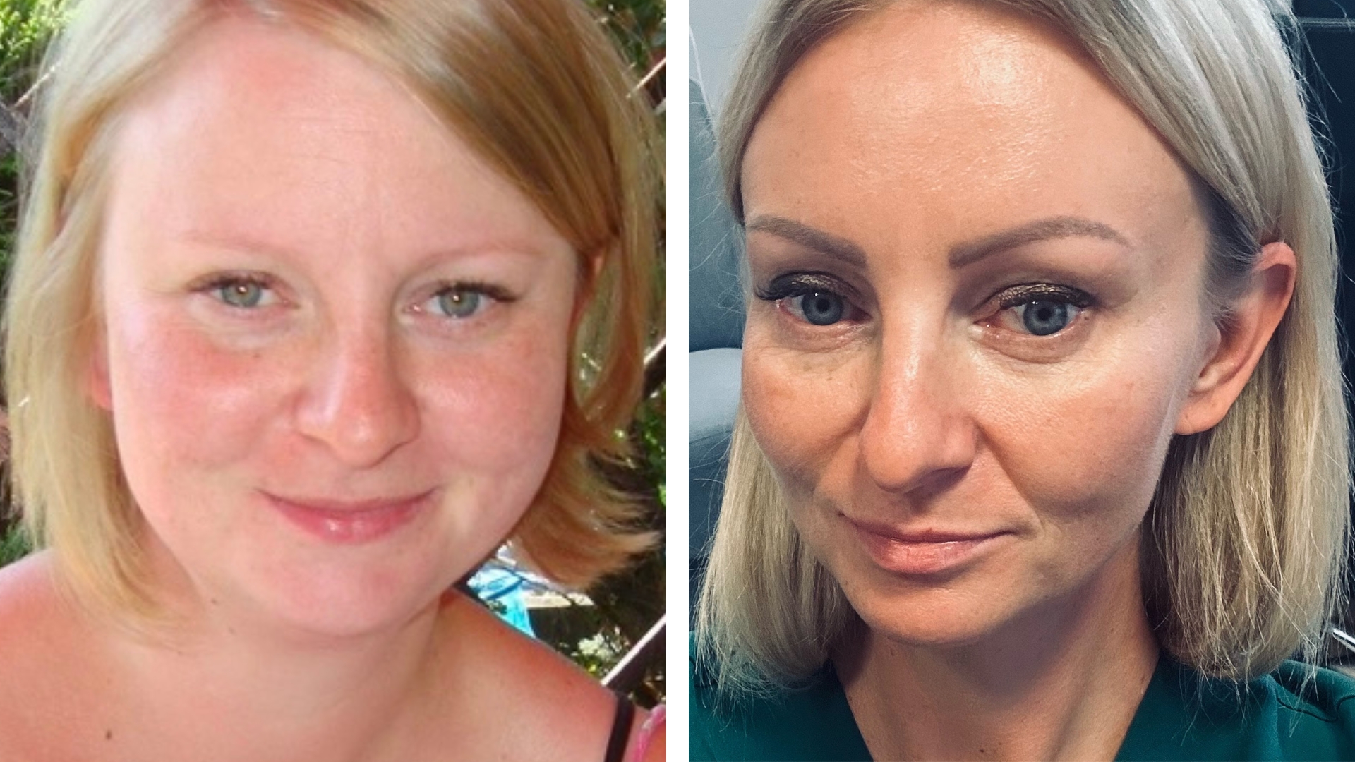 Osteofitoza krawędziowa – przyczyny, objawy, leczenie - HelloZdrowie